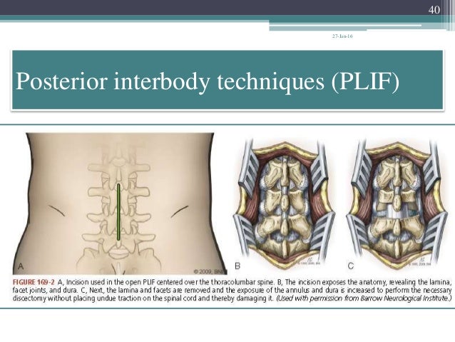 Lumbar interbody fusion indications techniques and complications