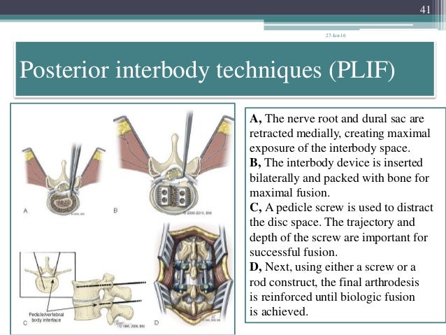Lumbar interbody fusion indications techniques and complications