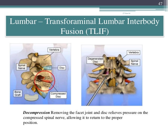 Lumbar interbody fusion indications techniques and complications