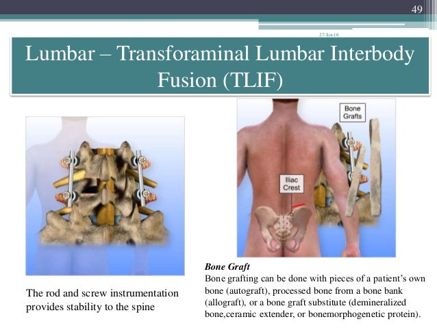 Lumbar interbody fusion indications techniques and complications