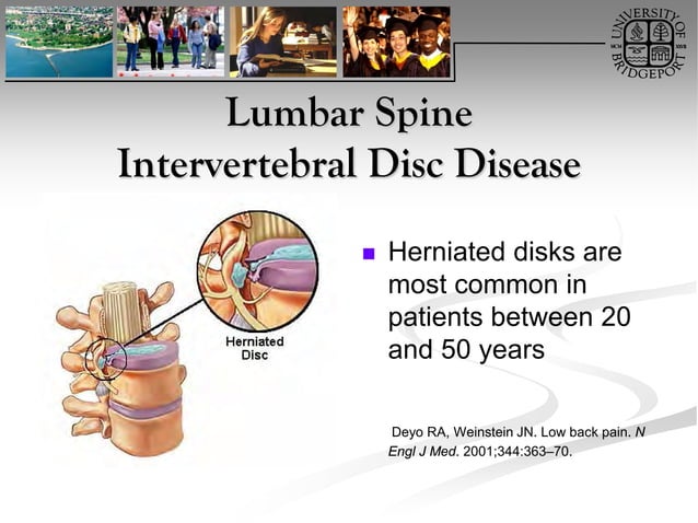 lumbar-radiculopathy estudio clinico.pdf