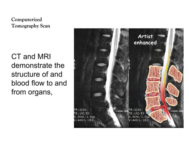 lumbar-radiculopathy estudio clinico.pdf