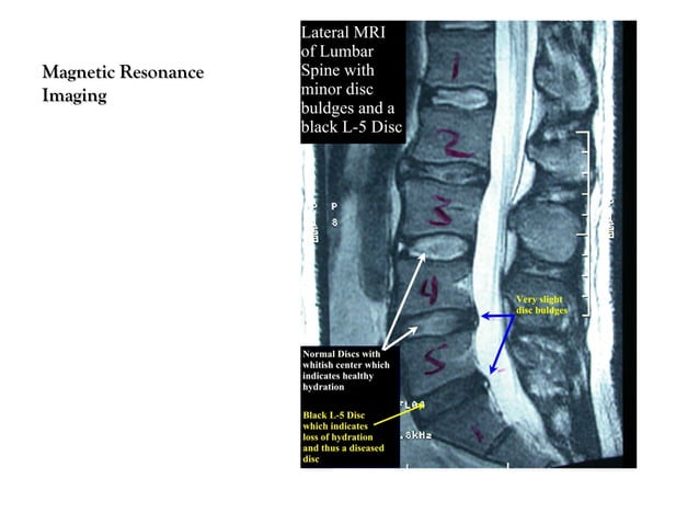lumbar-radiculopathy estudio clinico.pdf
