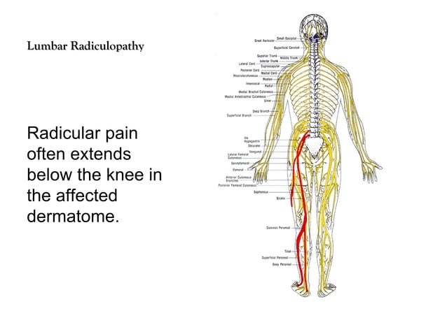 lumbar-radiculopathy estudio clinico.pdf