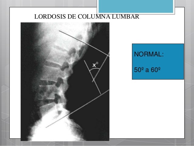 Radiología de la Columna
