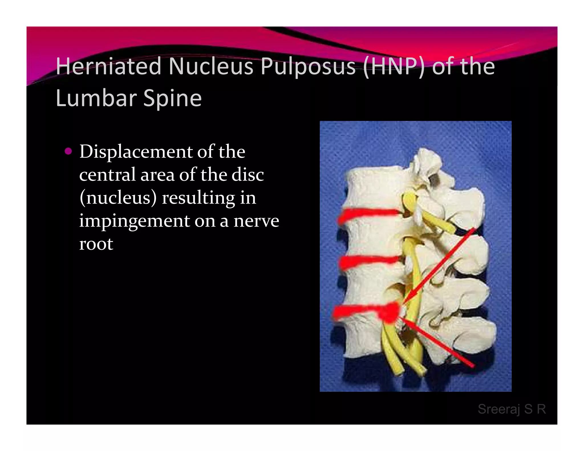 Lumbar and sacral Biomechanics | PDF
