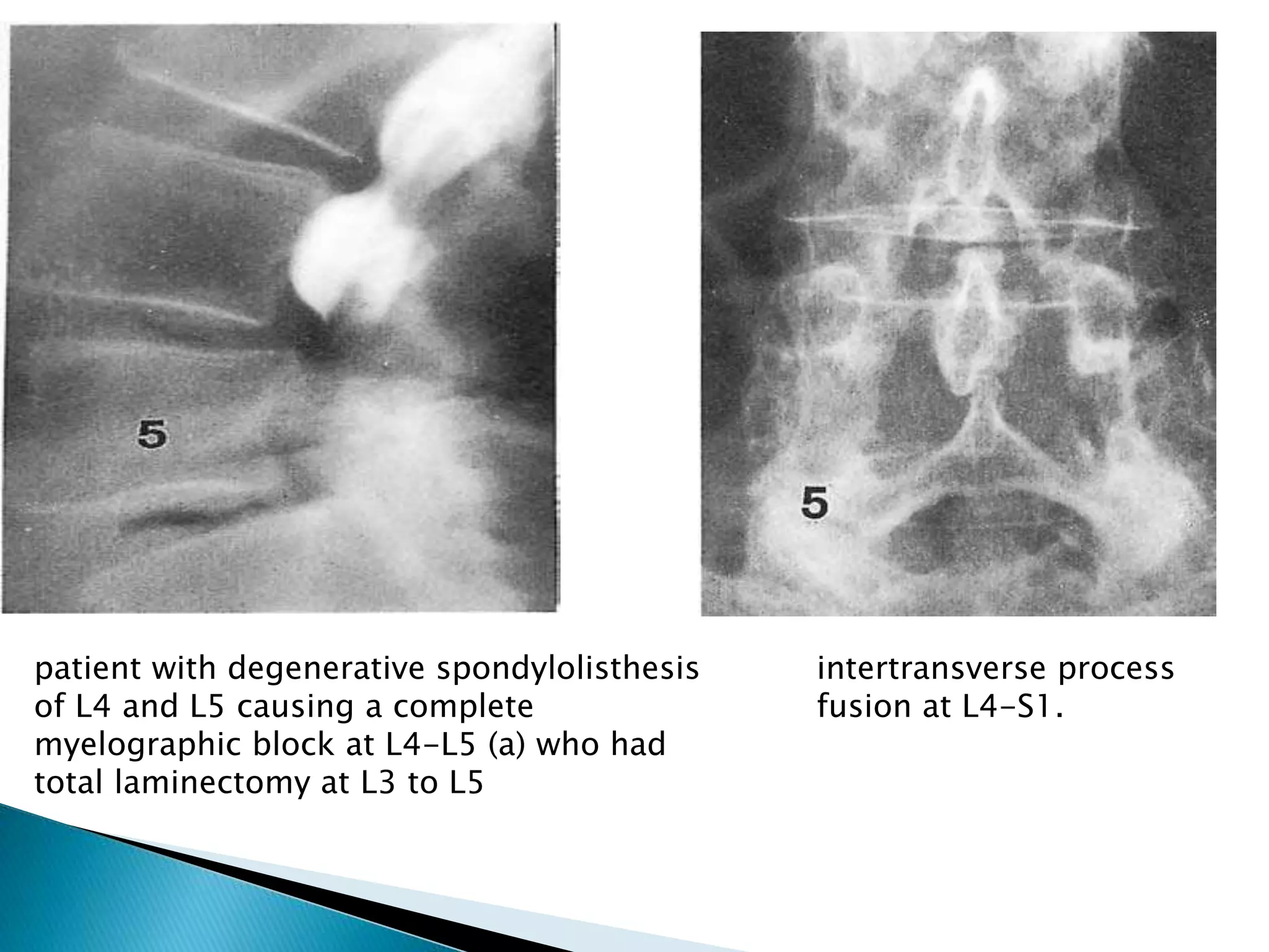 LUMBER CANAL STENOSIS ppt (5) | PPTX