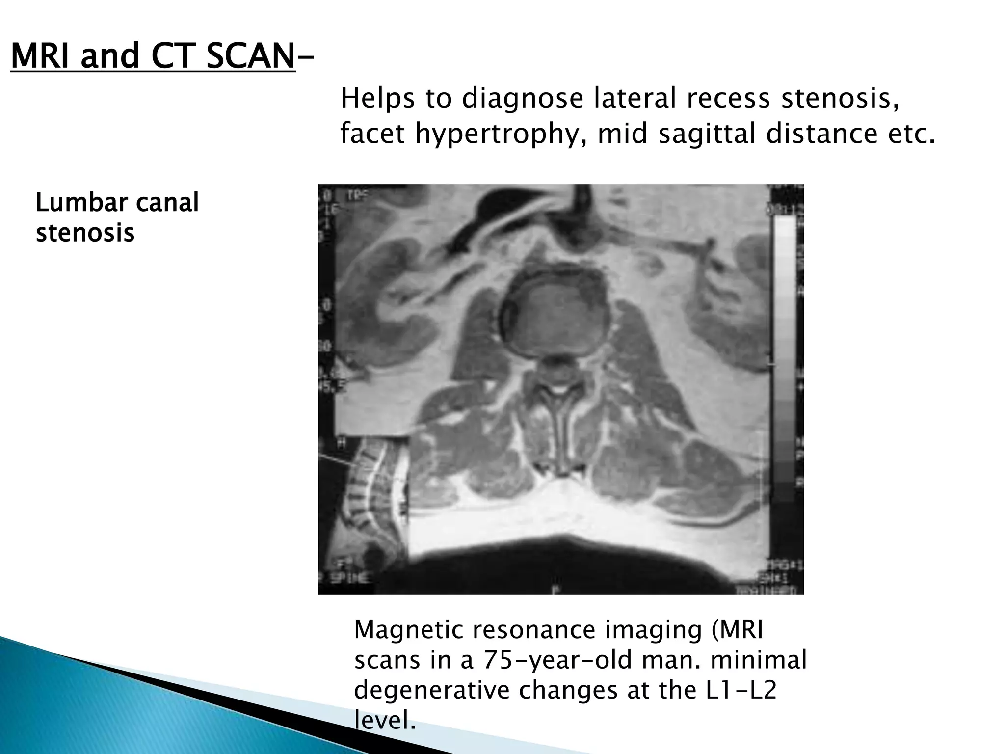 LUMBER CANAL STENOSIS ppt (5) | PPTX