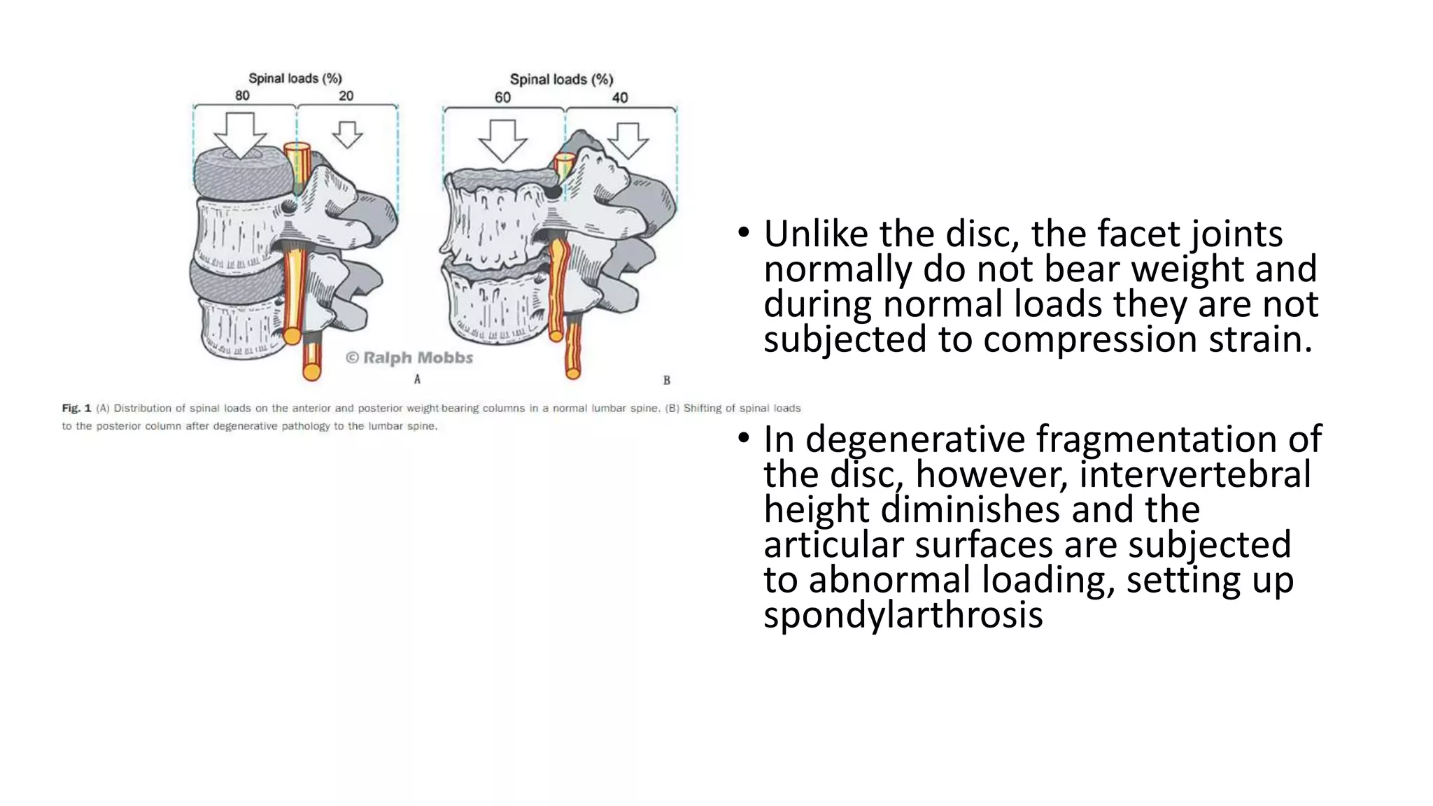 Lumbar degenerative spondylolisthesis | PPTX