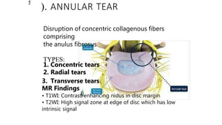 LUMBAR DISC DIEASE 1.3.pptx
