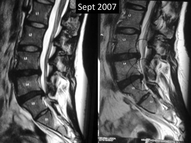 Lumbar disc extrusion –clinical relation with size | PPT