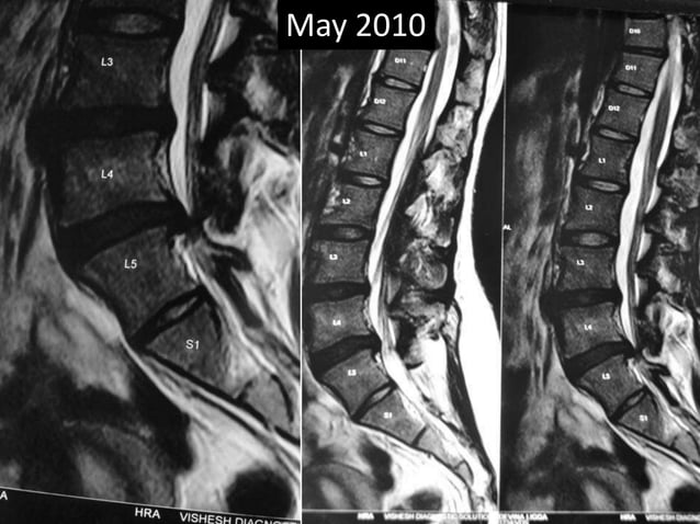 Lumbar disc extrusion –clinical relation with size | PPT