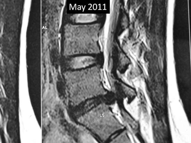 Lumbar disc extrusion –clinical relation with size | PPT