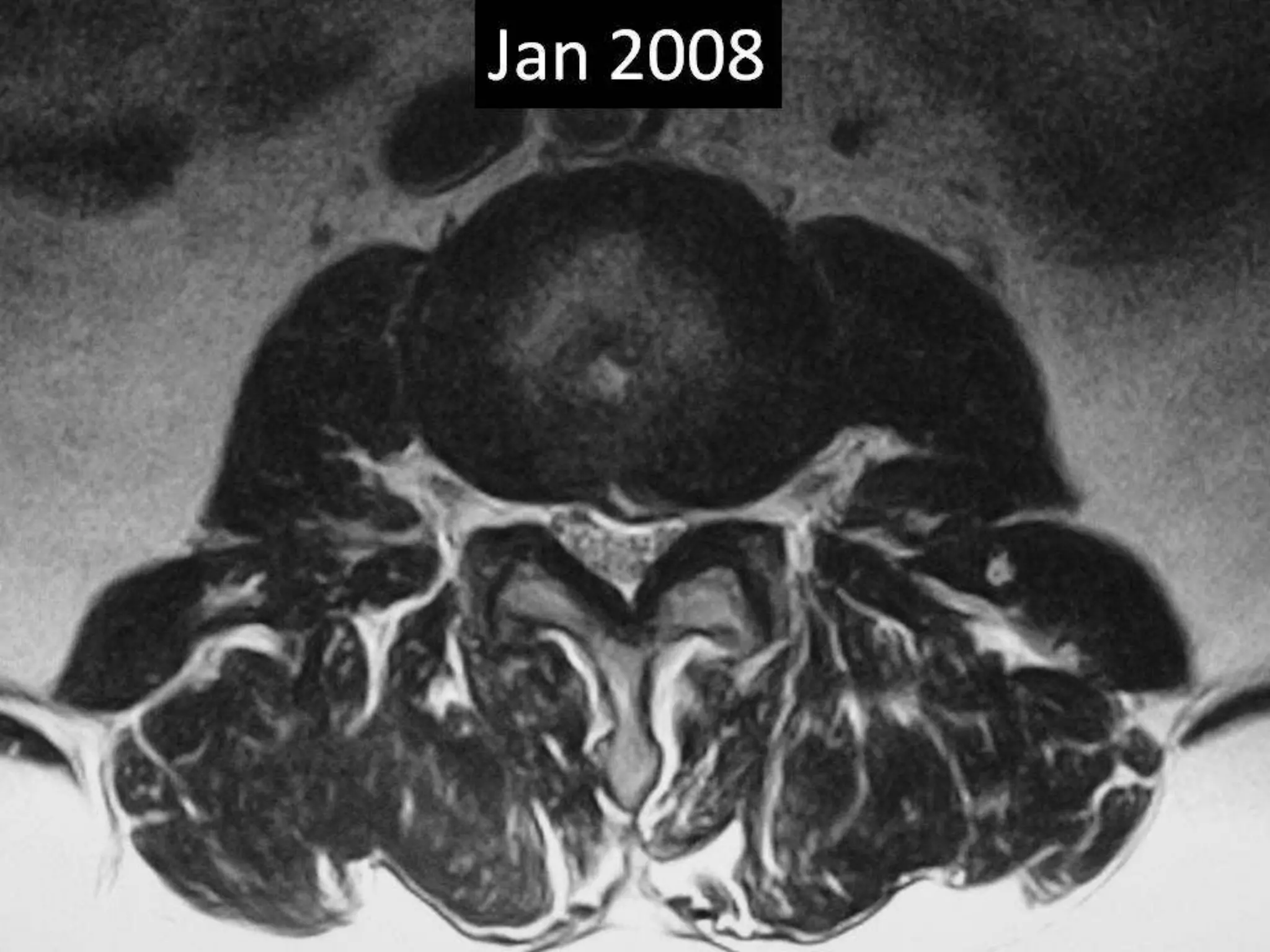 Lumbar disc extrusion –complete absorption | PPTX
