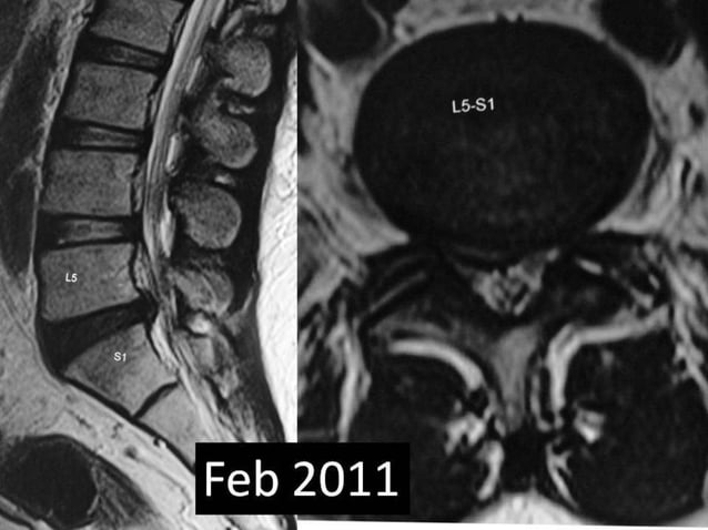 Lumbar disc extrusion –complete absorption | PPT