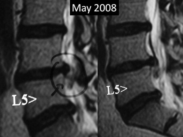 Lumbar disc extrusion –complete absorption | PPT