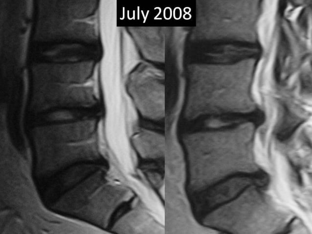 Lumbar disc extrusion –complete absorption | PPT