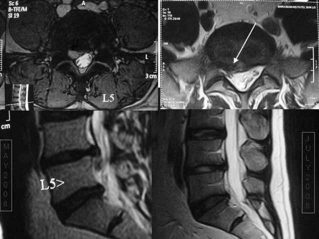 Lumbar disc extrusion –complete absorption | PPT