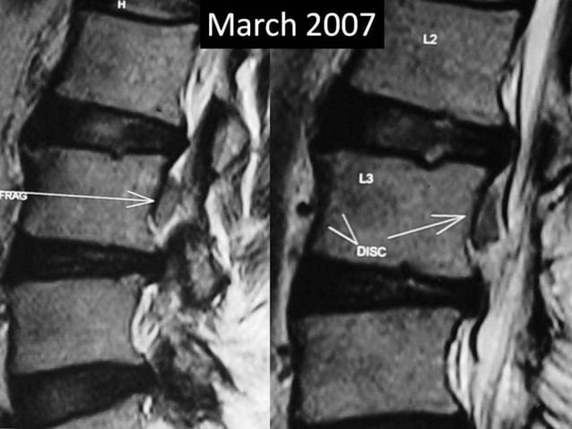 Lumbar disc extrusion –complete absorption | PPT
