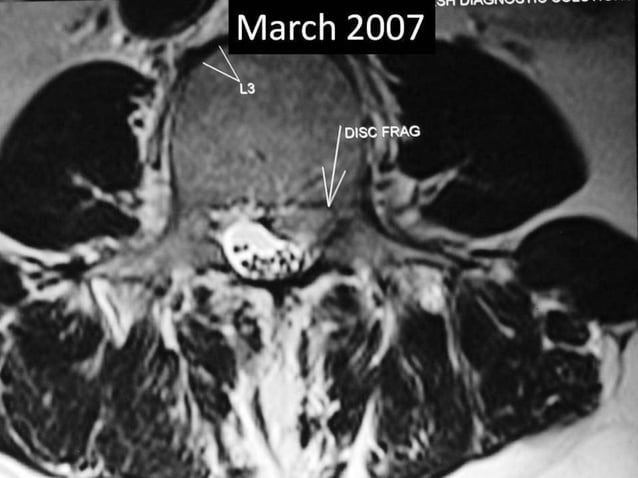 Lumbar disc extrusion –complete absorption | PPT