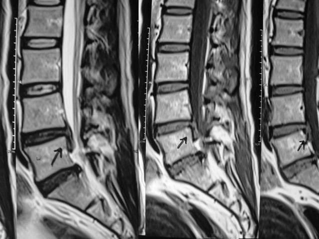 Lumbar disc extrusion –complete absorption | PPT