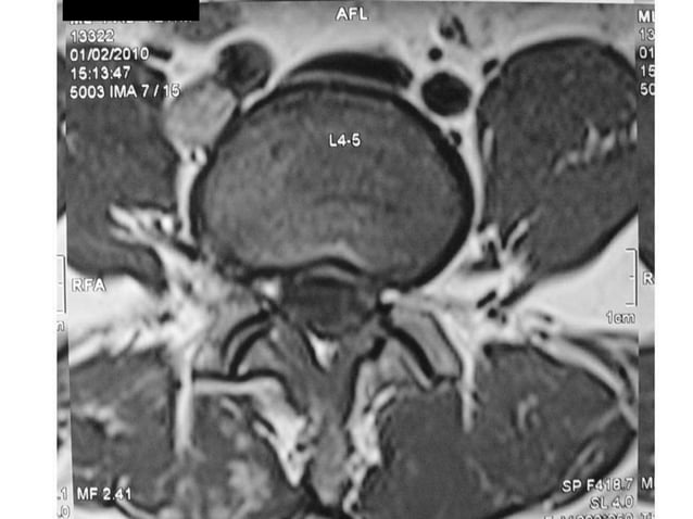 Lumbar disc extrusion –complete absorption | PPT
