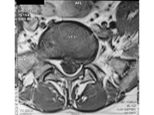 Lumbar disc extrusion –complete absorption | PPT