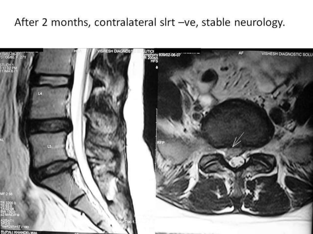 Lumbar disc extrusion –complete absorption | PPT