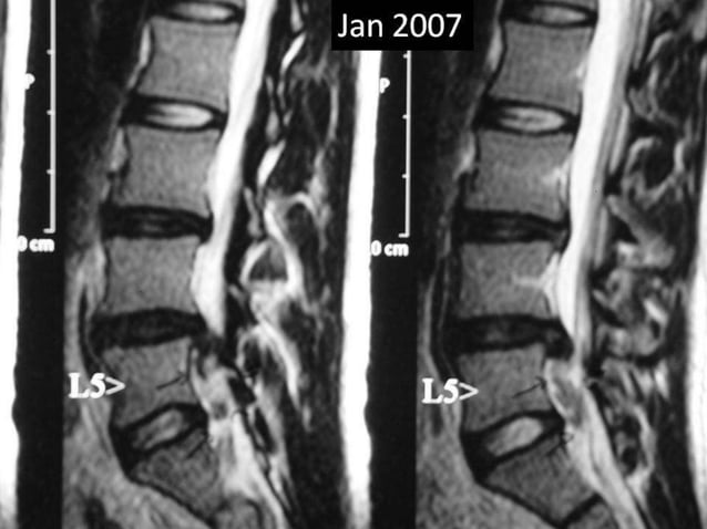 Lumbar disc extrusion –complete absorption | PPT