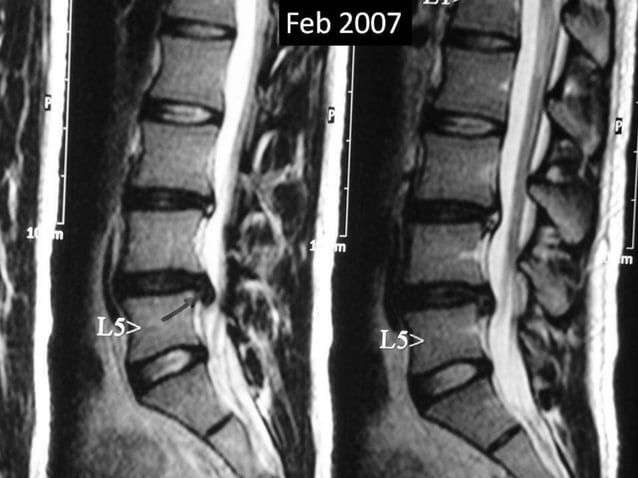 Lumbar disc extrusion –complete absorption | PPT