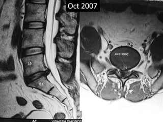 Lumbar disc extrusion –complete absorption | PPTX
