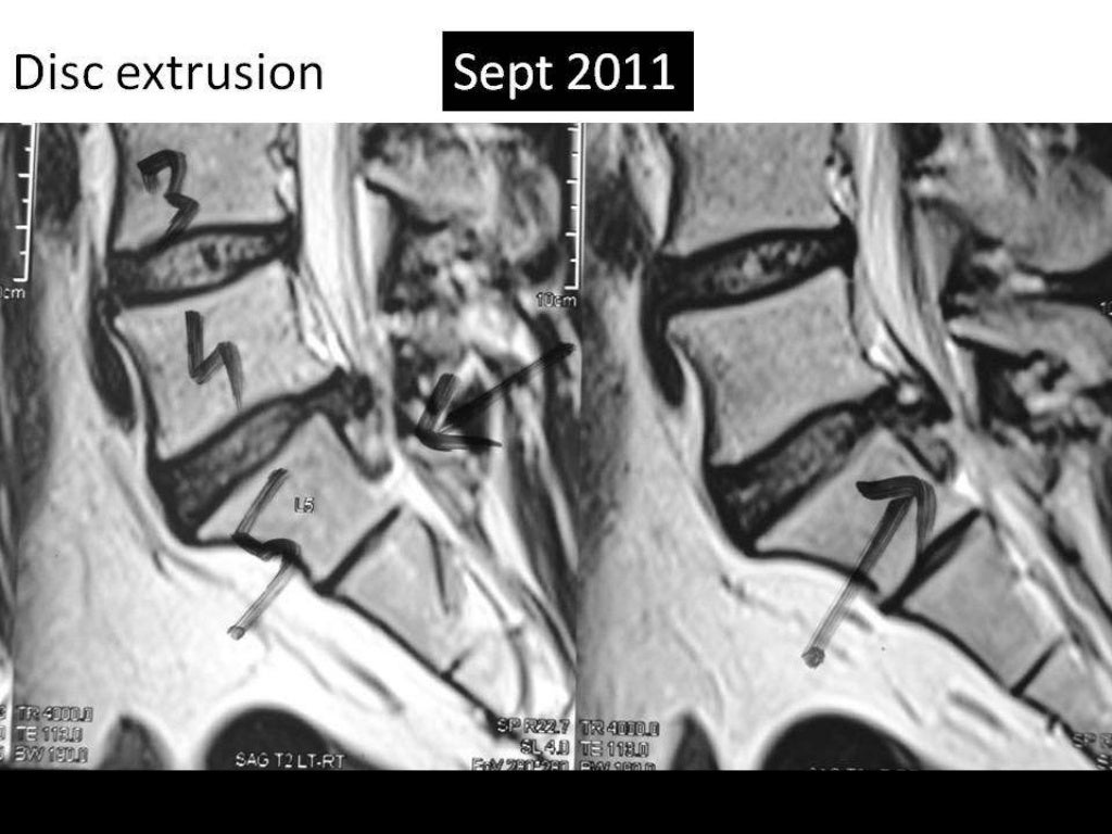 Lumbar disc extrusion – recurrence