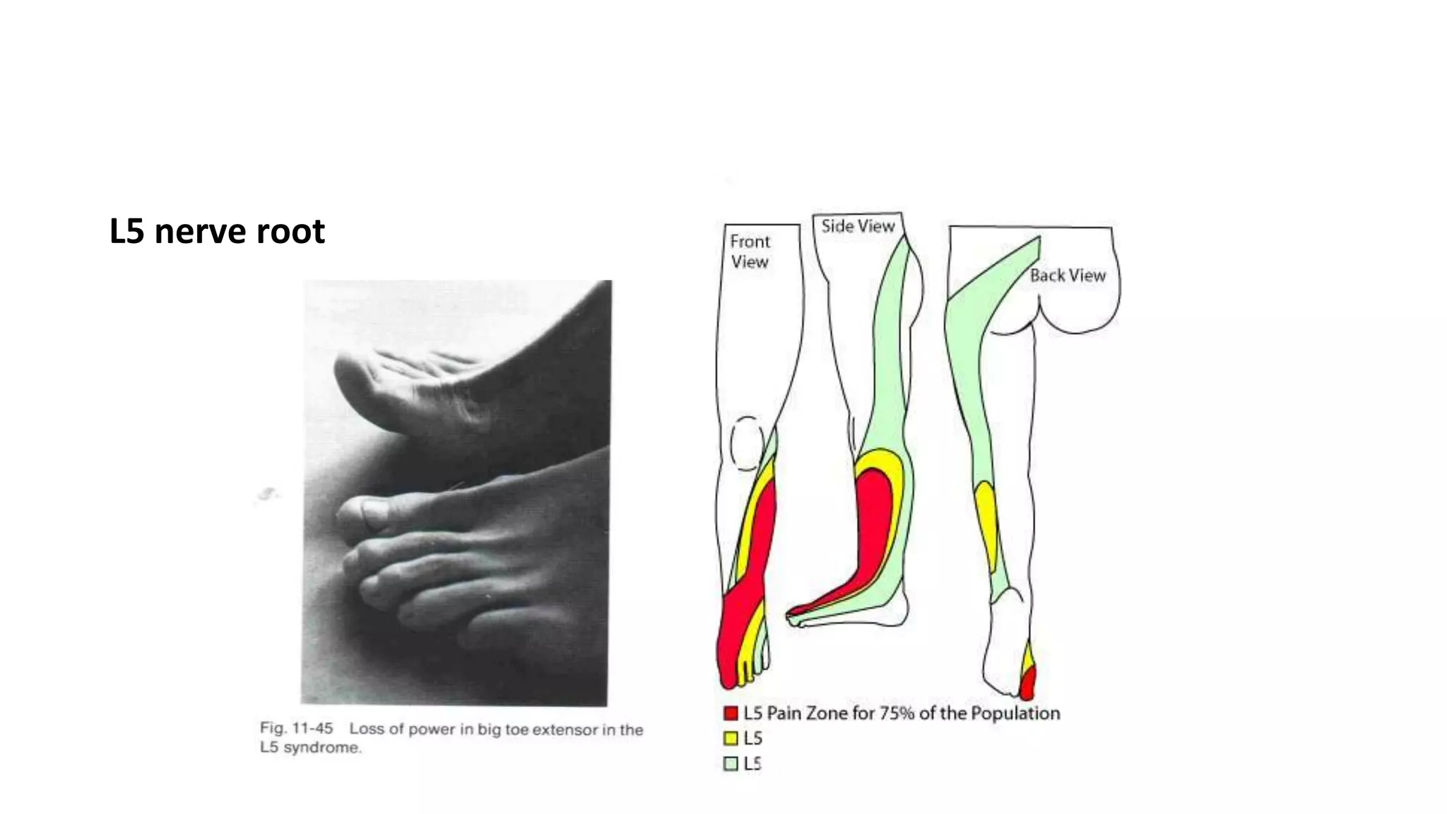 LUMBAR DISC HERNIATION.pptx