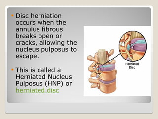 Lumbar disc herniation- a cause of disability .ppt