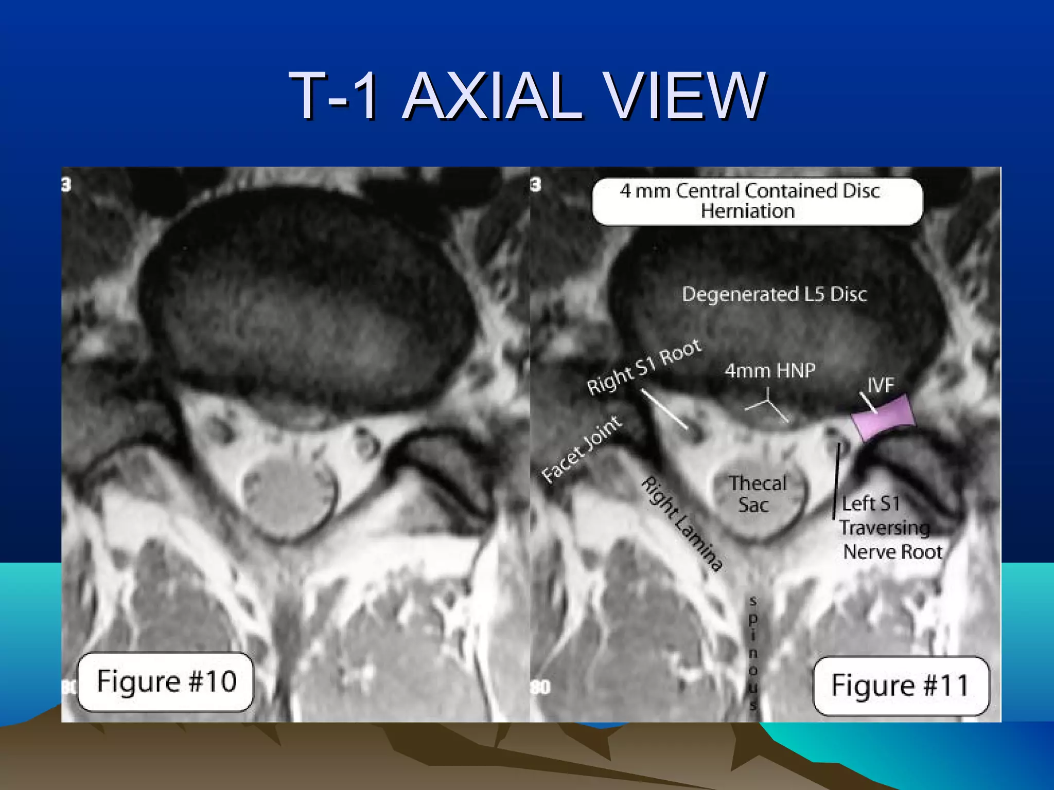 Lumbar disc presentation dr ajay bajaj neurosurgeon | PPT