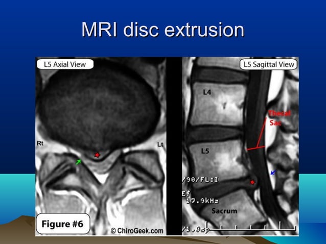 Lumbar disc presentation dr ajay bajaj neurosurgeon | PPT