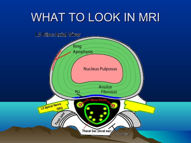 Lumbar disc presentation dr ajay bajaj neurosurgeon | PPT