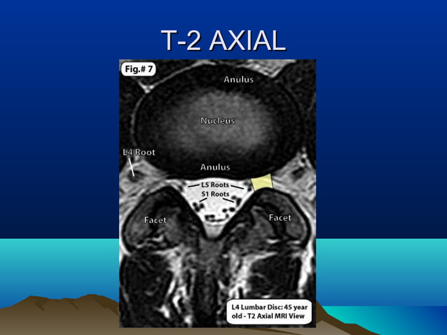 Lumbar disc presentation dr ajay bajaj neurosurgeon | PPT