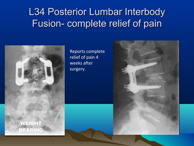 Lumbar disc presentation dr ajay bajaj neurosurgeon | PPT