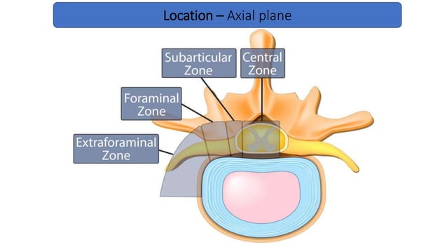 Lumbar Disc prolapse - Basics.pptx | Bone and Joint Conditions ...