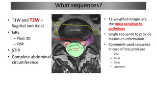 Lumbar Disc prolapse - Basics.pptx