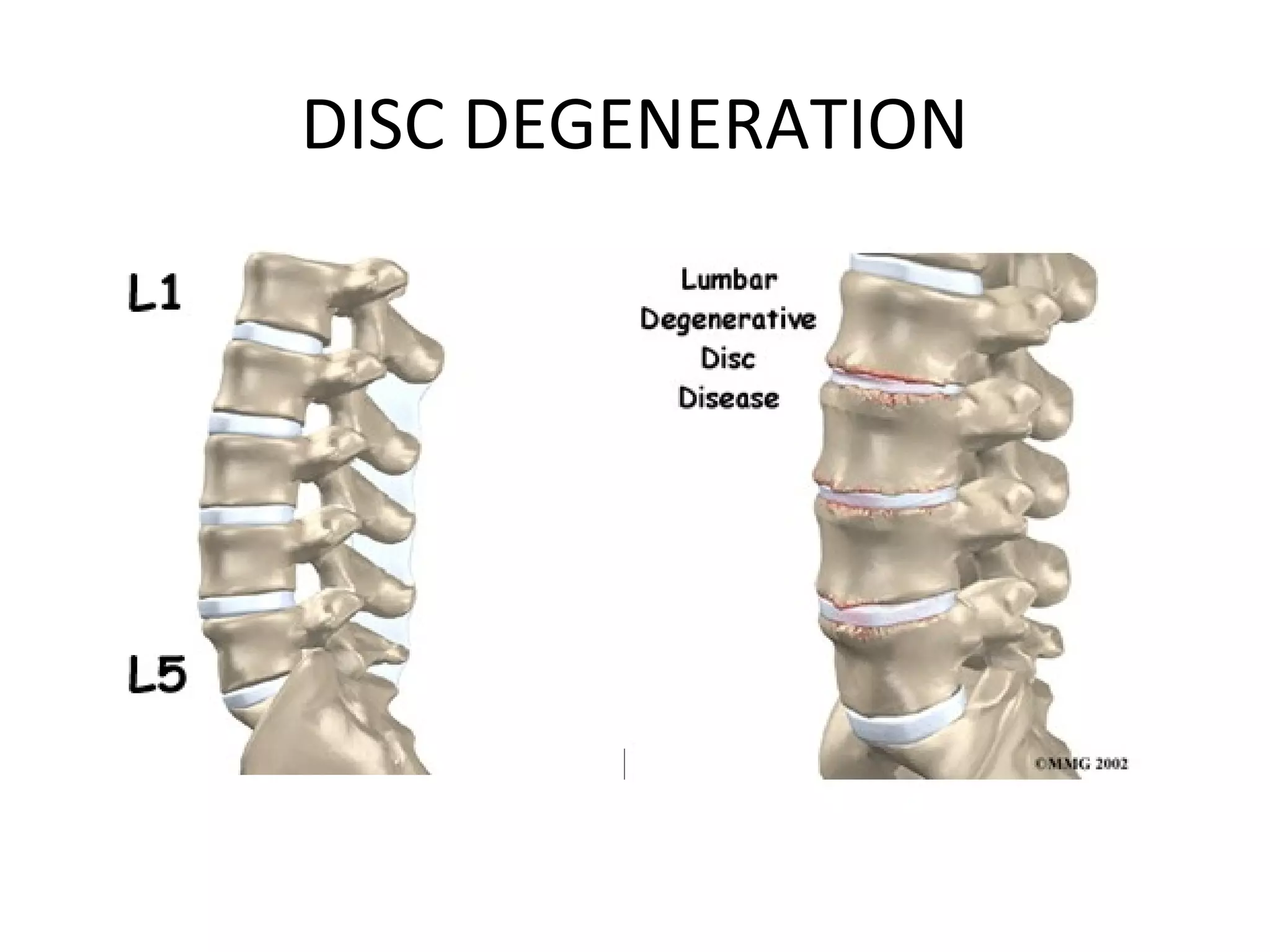 Lumbar disc prolapse | PPT