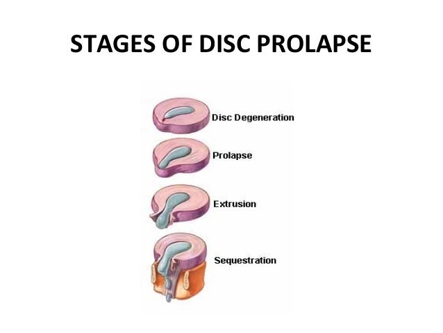 Lumbar disc prolapse