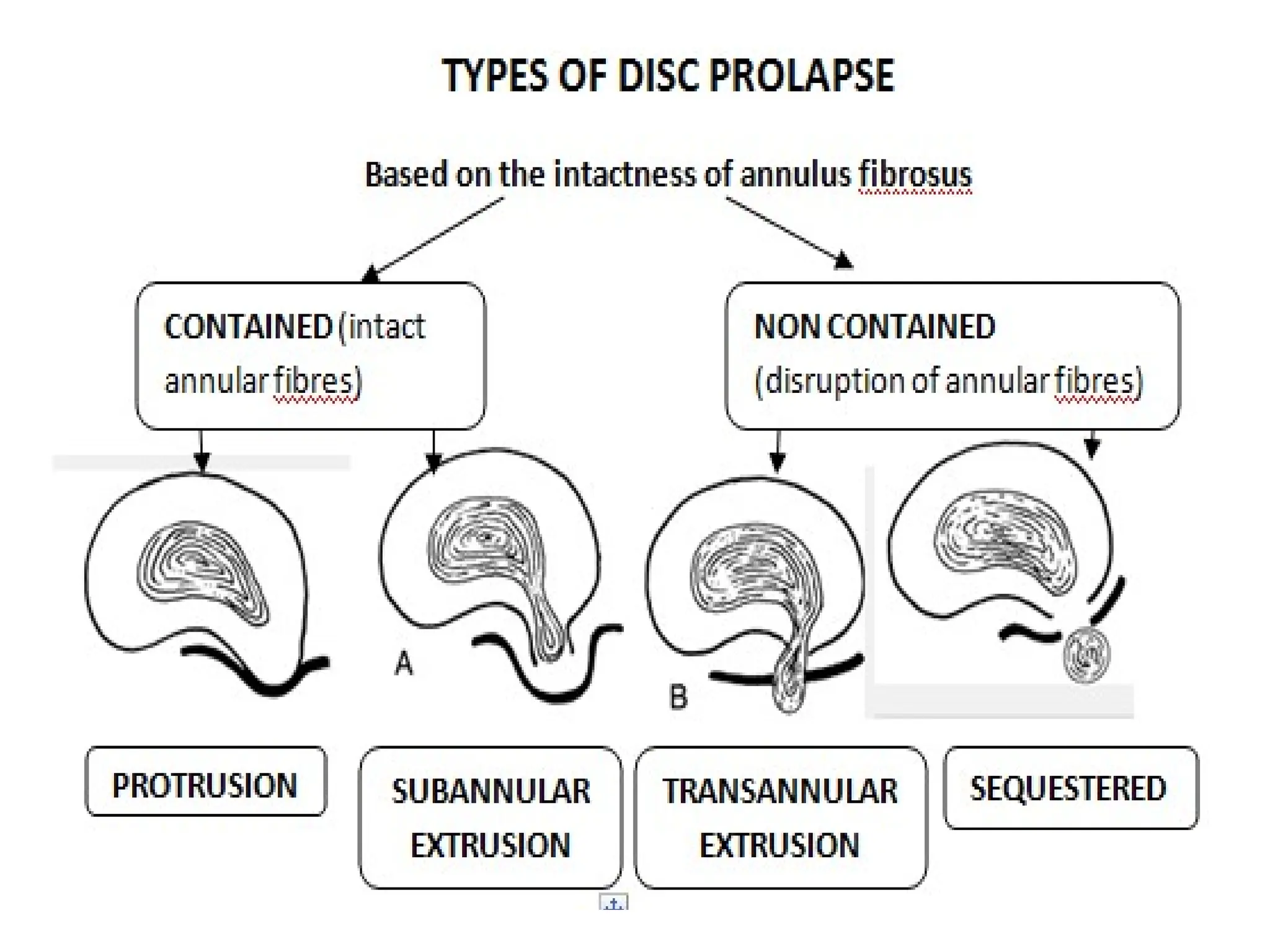 lumbardiscprolapse3-130219095421-phpapp01 (1).pdf