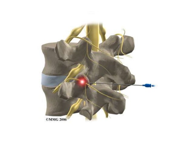 Lumbar facet syndrome | PPT