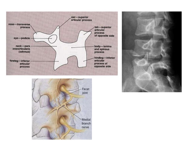 Lumbar facet syndrome | PPT