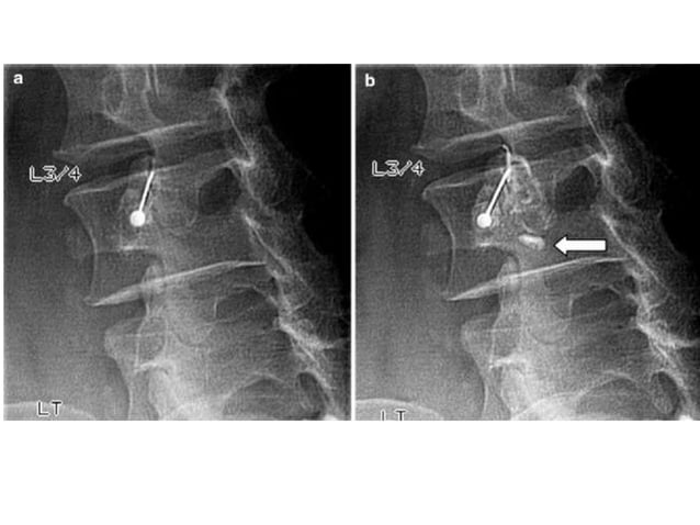 Lumbar facet syndrome | PPT
