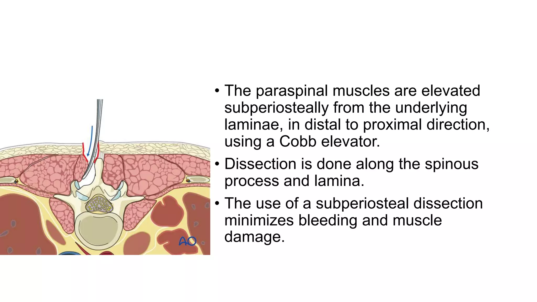 Lumbar interbody fusion.pptx
