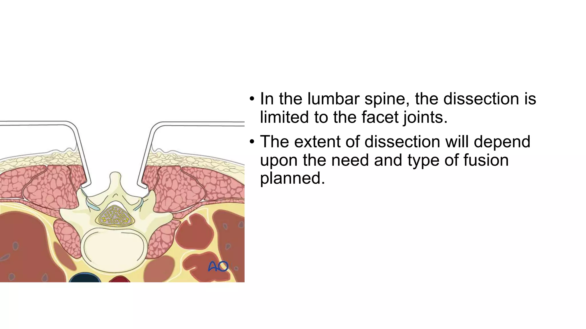 Lumbar interbody fusion.pptx