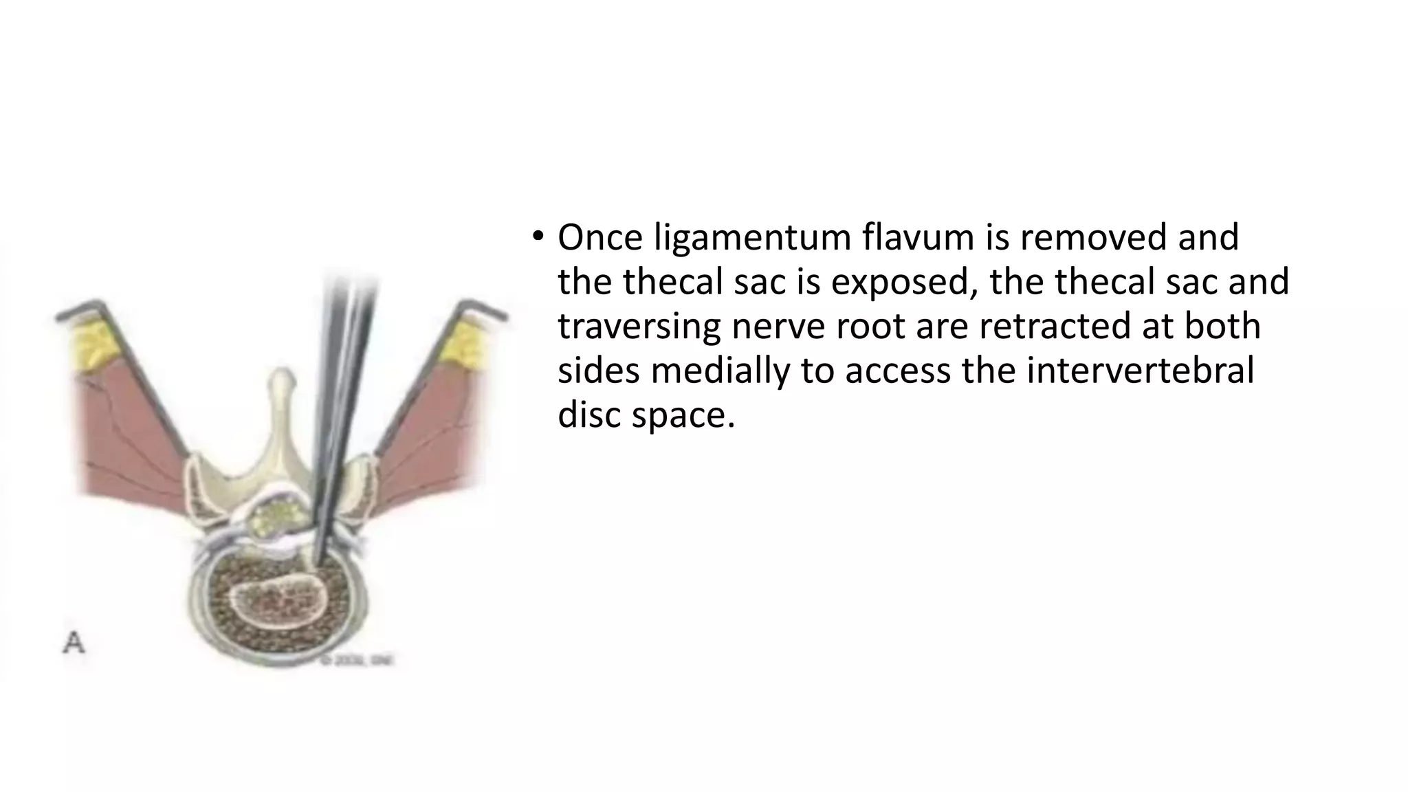 Lumbar interbody fusion.pptx